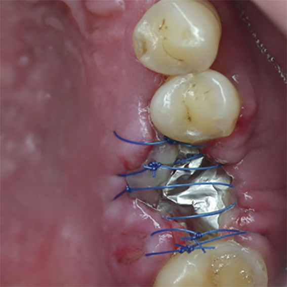 Membranes – Implant Resources Centre (Far East) Limited